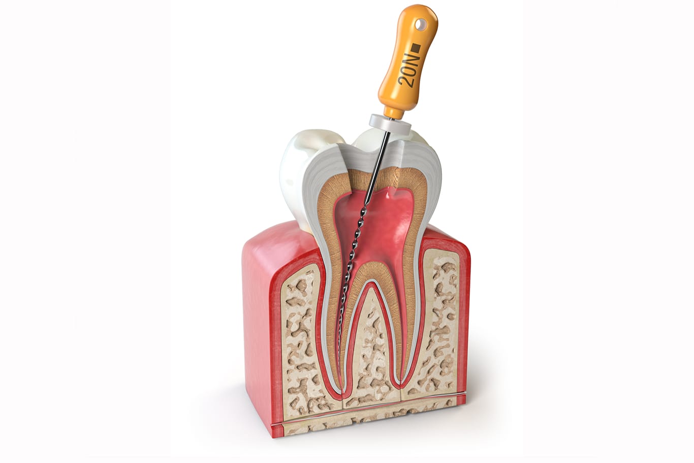 Endodontics in Citrus Heights, CA - Root Canal Treatment